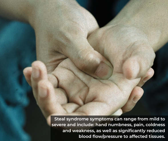 Dialysis Access | Stony Brook Medicine